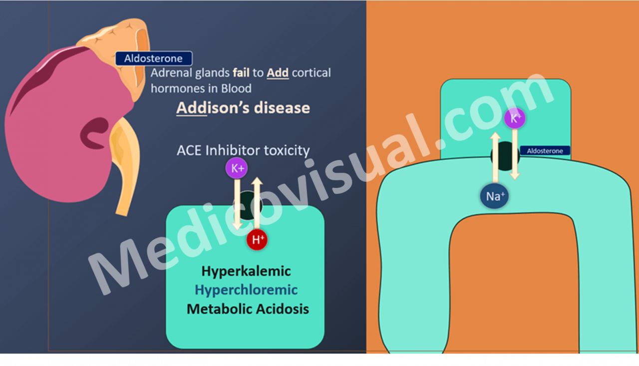 Demystifying Anion Gap