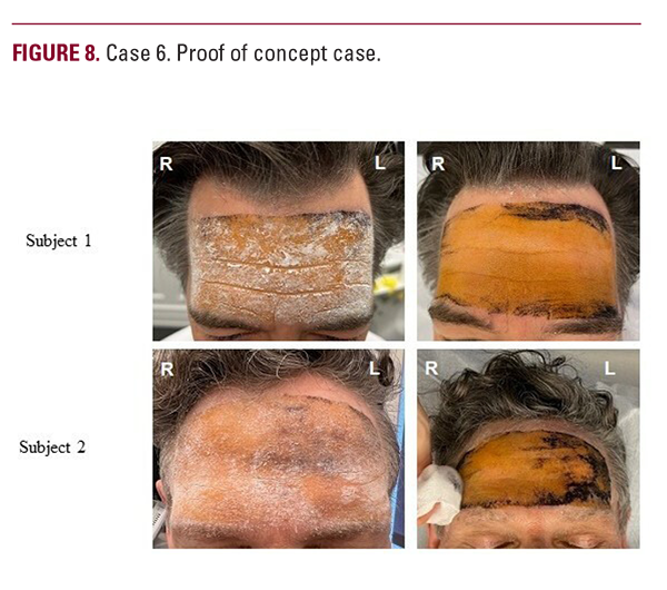 polypeptide injections