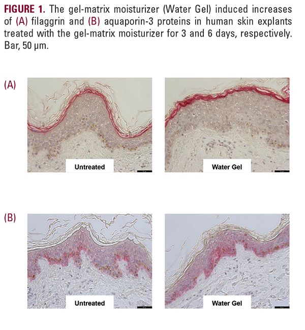 Skin Improvements in Acne Vulgaris Patients Using Gel-Matrix ...
