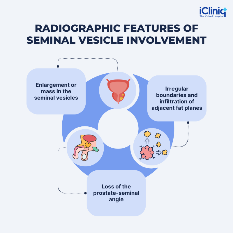 What Is the Role of the Seminal Vesicles in Prostate Cancer?