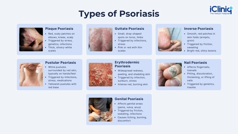 psoriasis cks